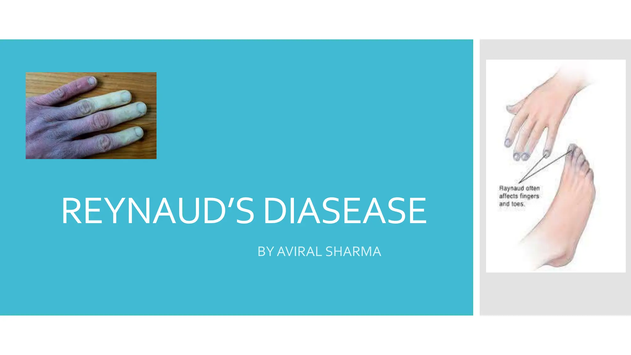 REYNAUD’S DIASEASE. power point presenatation | PPTX