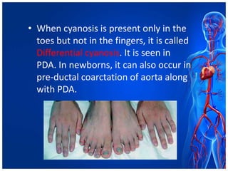 Reza cyanosis | PPT