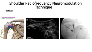 RFA targets conventional,pulsed.pptx
