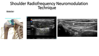 RFA targets conventional,pulsed.pptx
