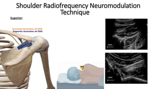 RFA targets conventional,pulsed.pptx