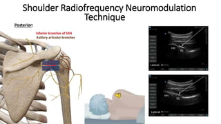 RFA targets conventional,pulsed.pptx