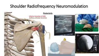 RFA targets conventional,pulsed.pptx