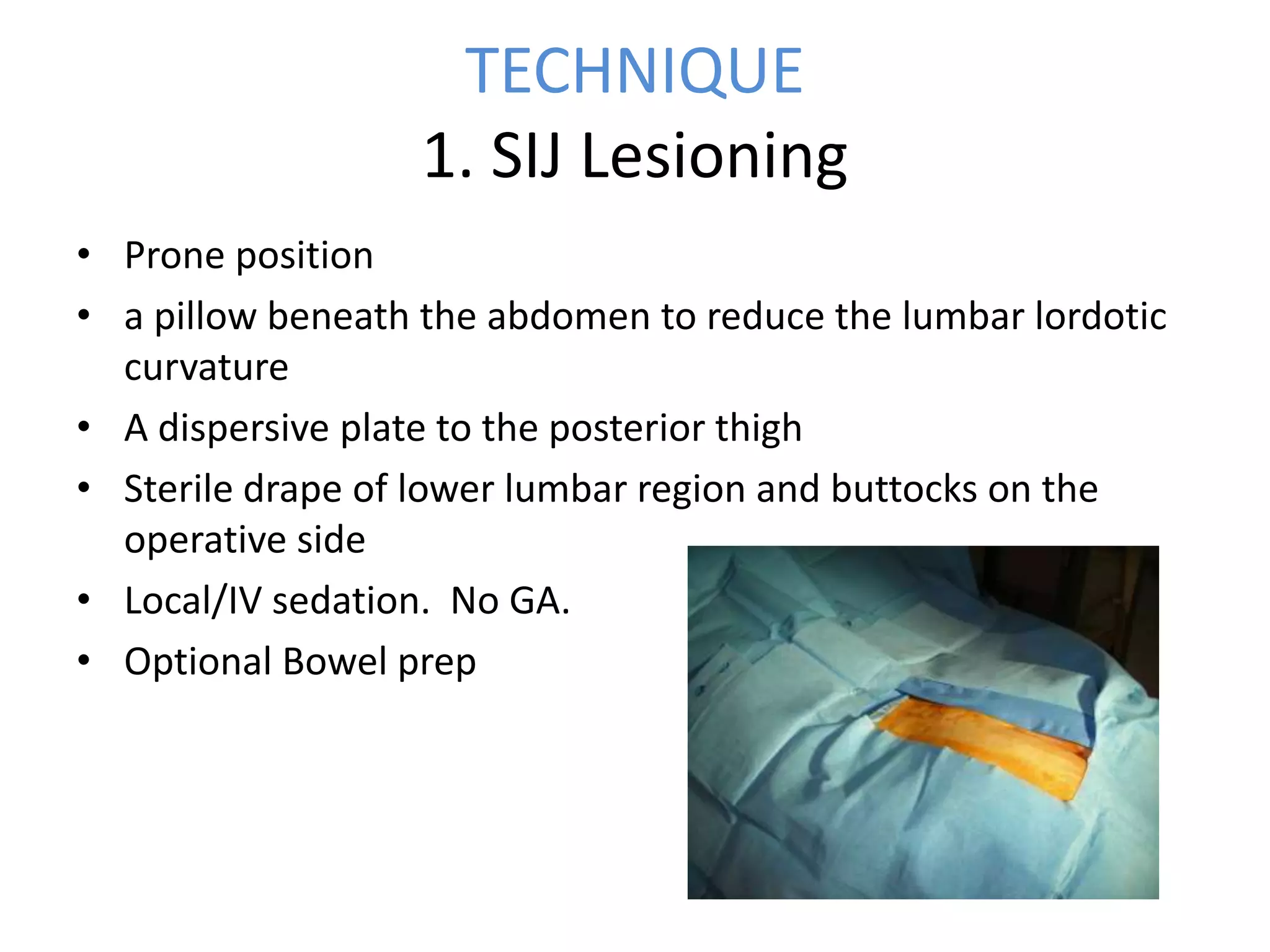 Sacroiliac Joint RF Denervation | PPTX