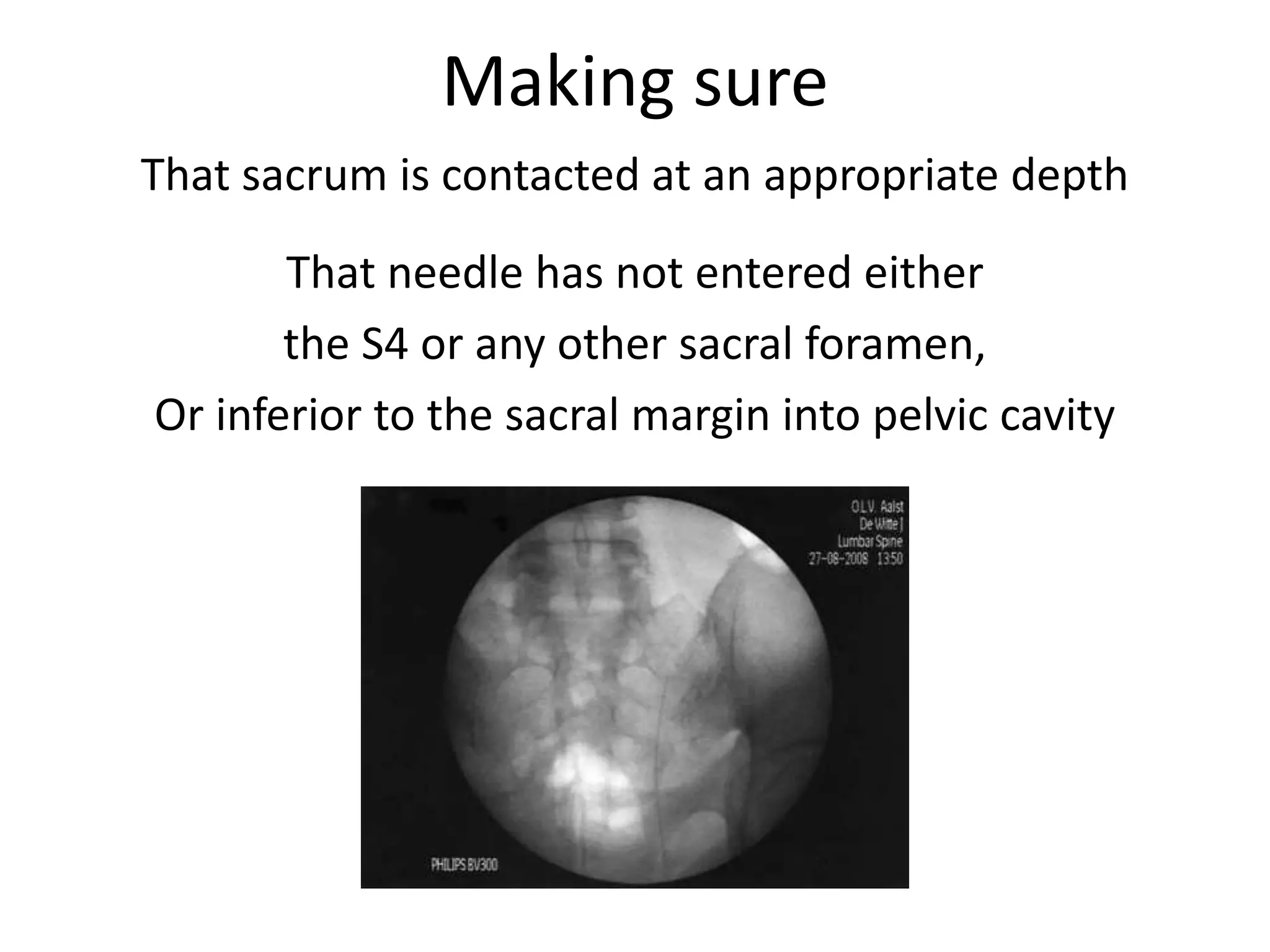 Sacroiliac Joint RF Denervation | PPTX