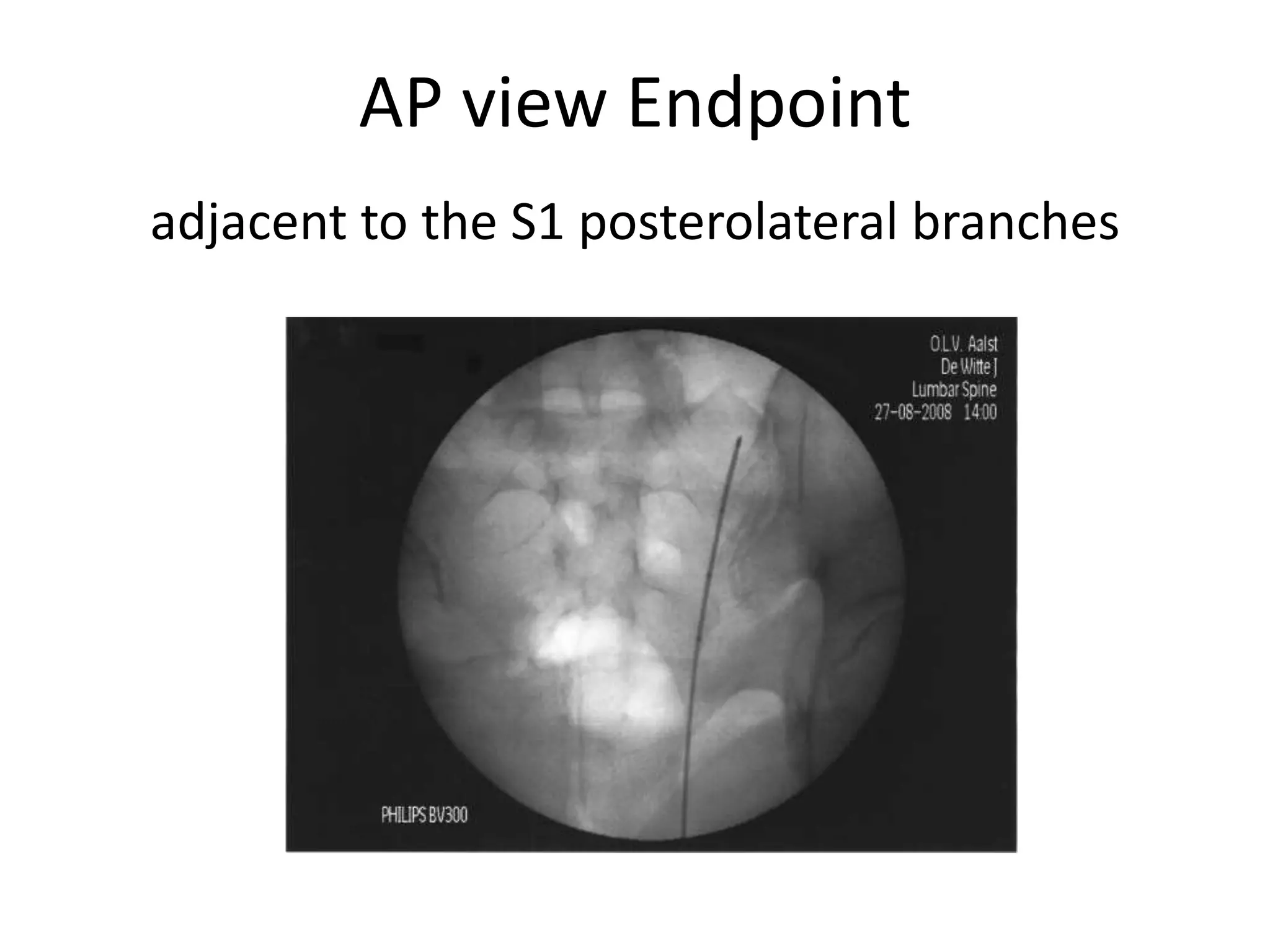 Sacroiliac Joint RF Denervation | PPTX