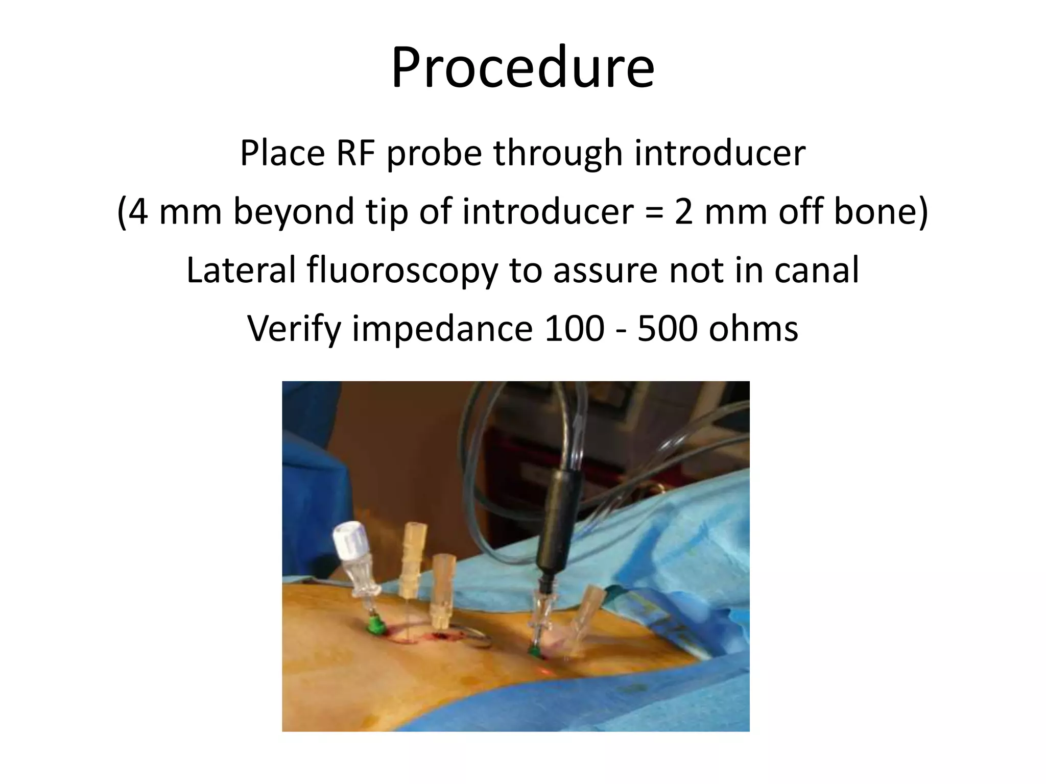 Sacroiliac Joint RF Denervation | PPTX