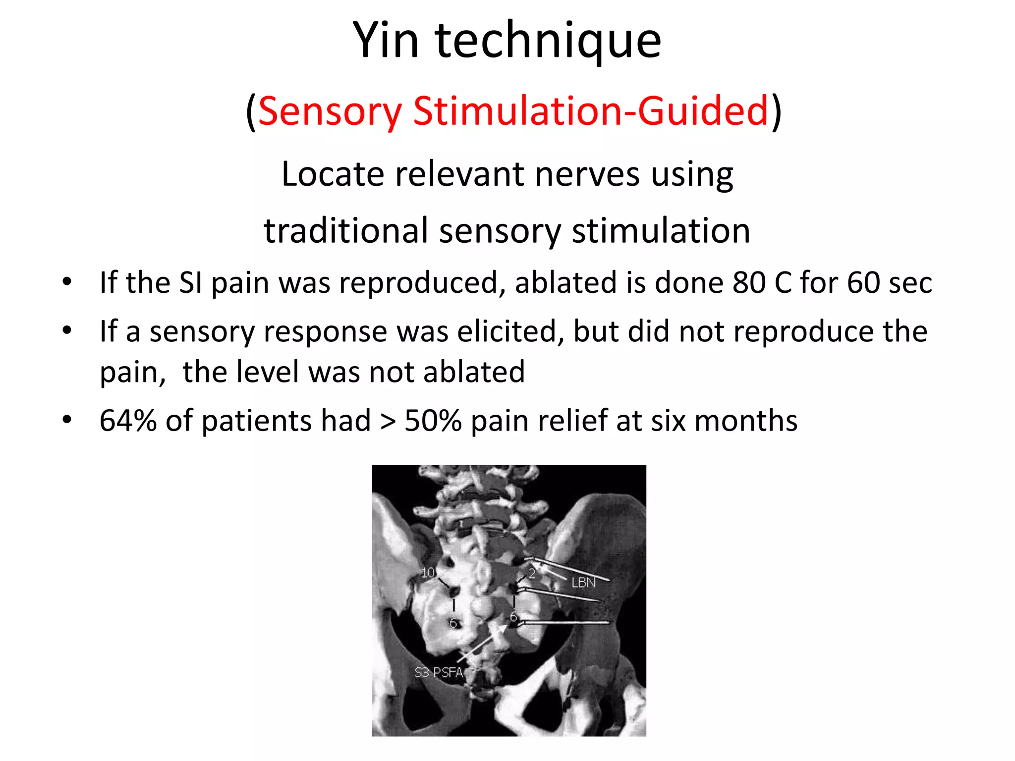 Sacroiliac Joint RF Denervation | PPTX