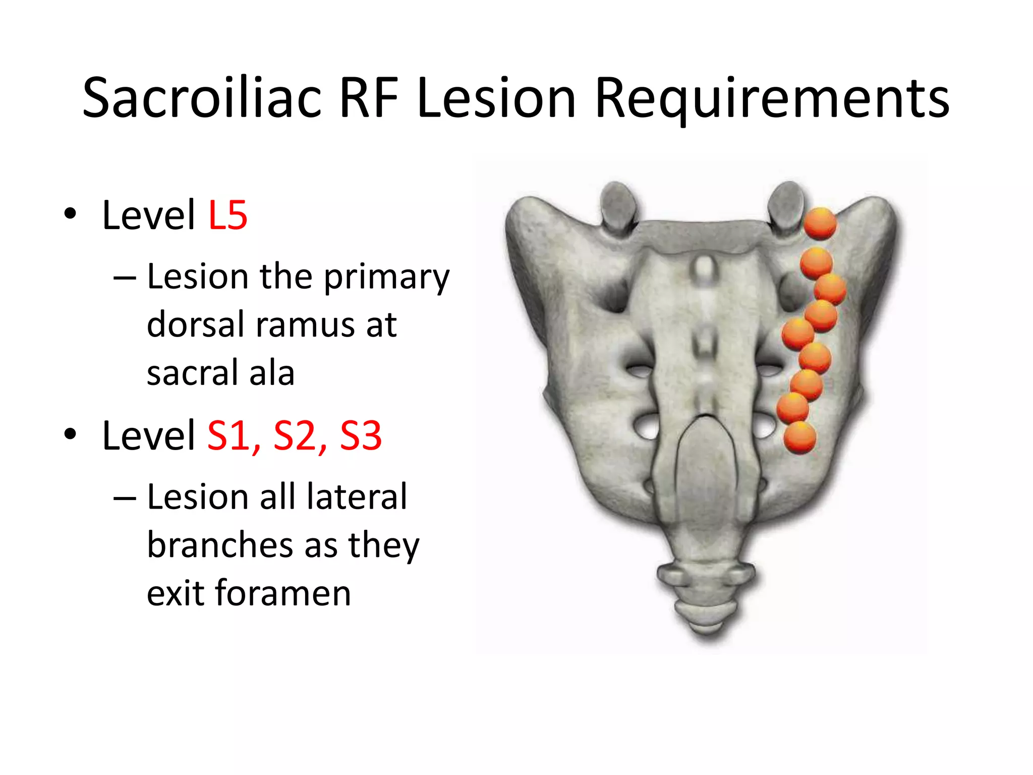 Sacroiliac Joint RF Denervation | PPTX | Bone and Joint Conditions ...