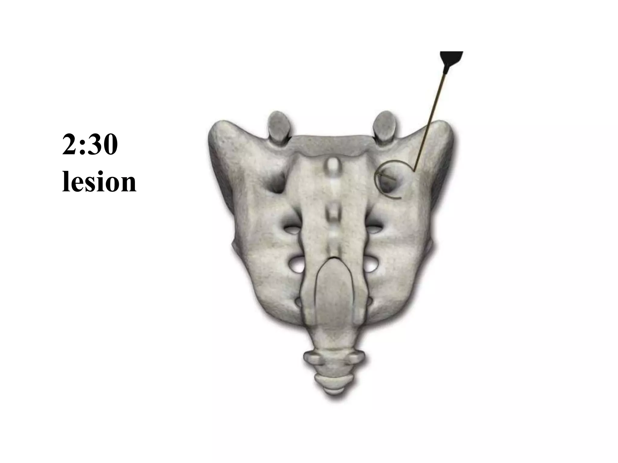 Sacroiliac Joint RF Denervation | PPTX