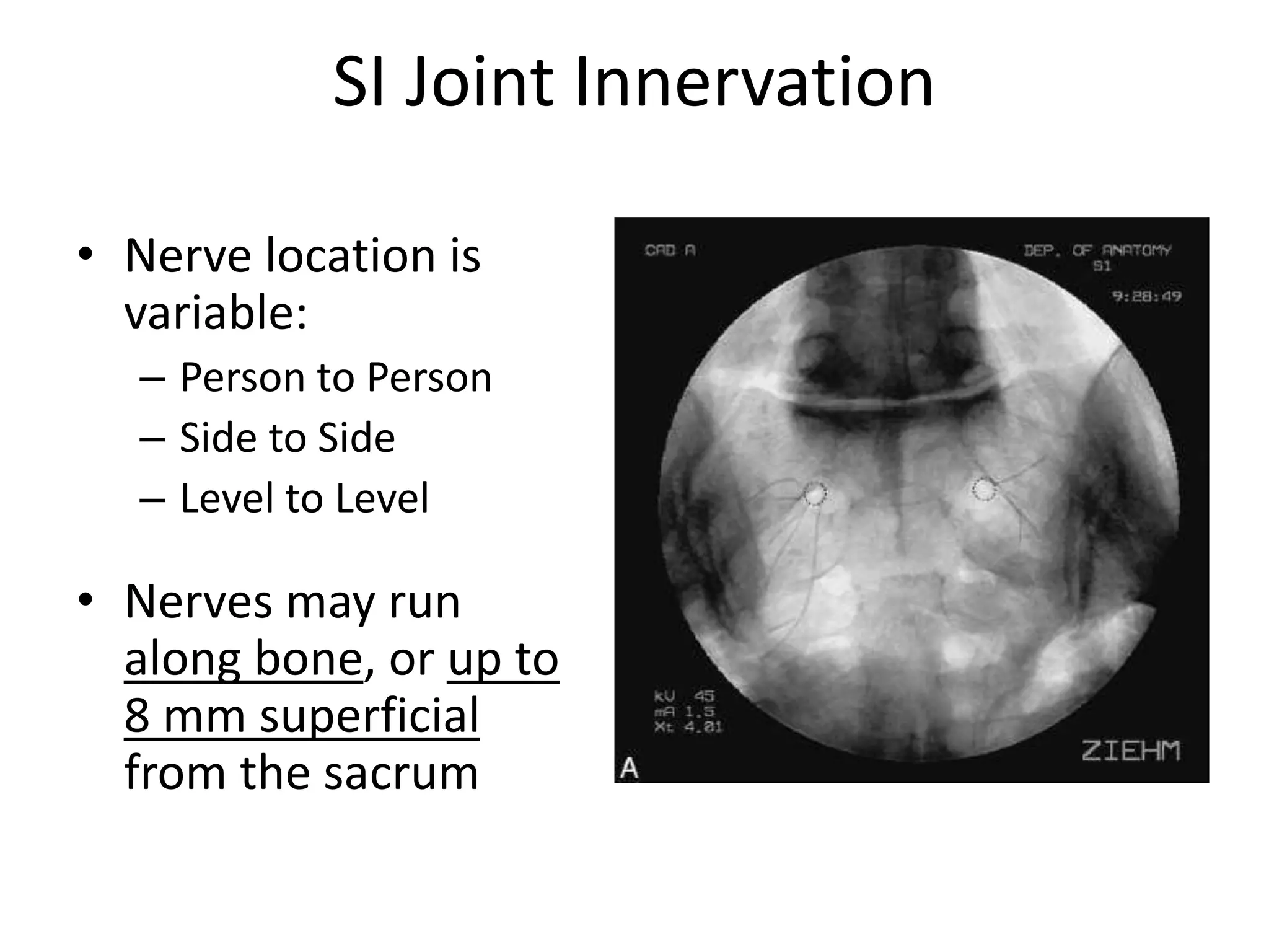 Sacroiliac Joint RF Denervation | PPTX