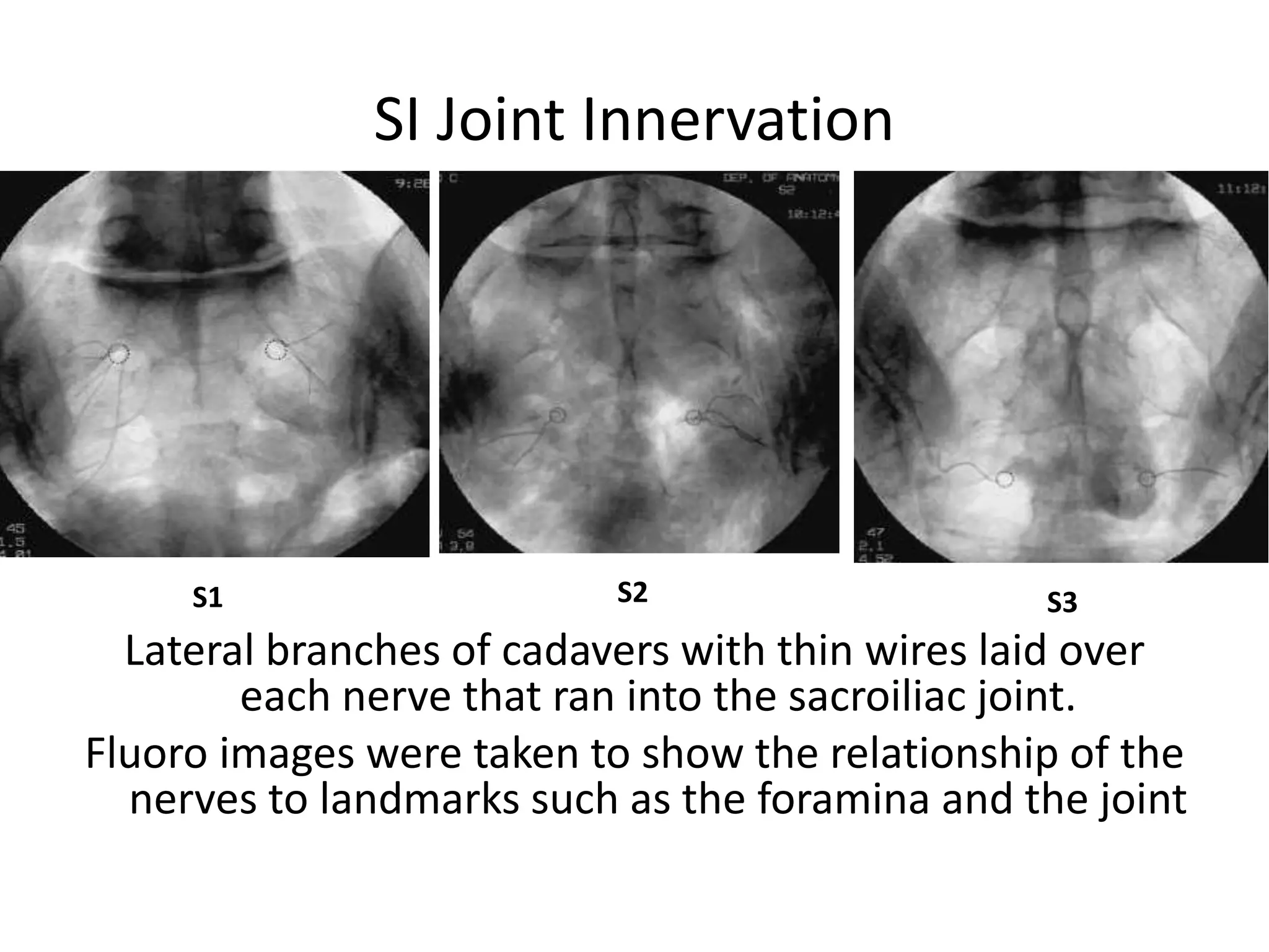Sacroiliac Joint RF Denervation | PPTX