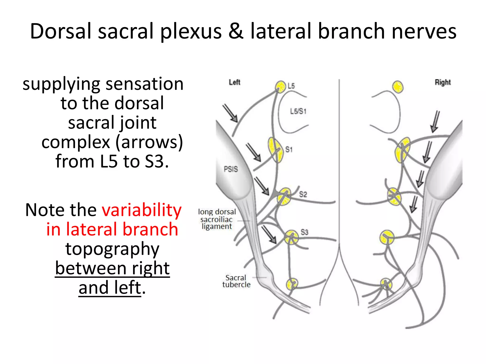 Sacroiliac Joint RF Denervation | PPTX