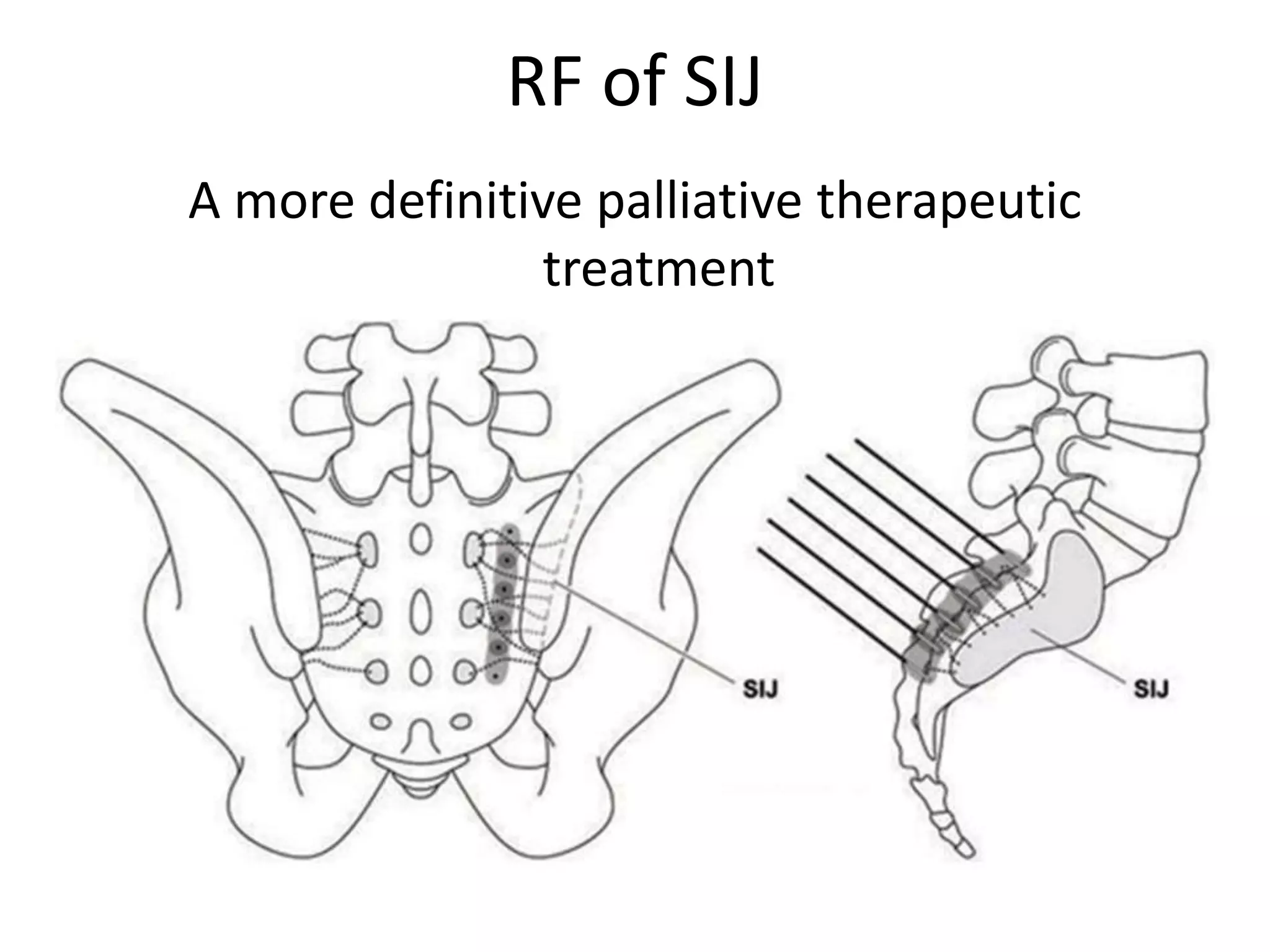 Sacroiliac Joint RF Denervation | PPTX