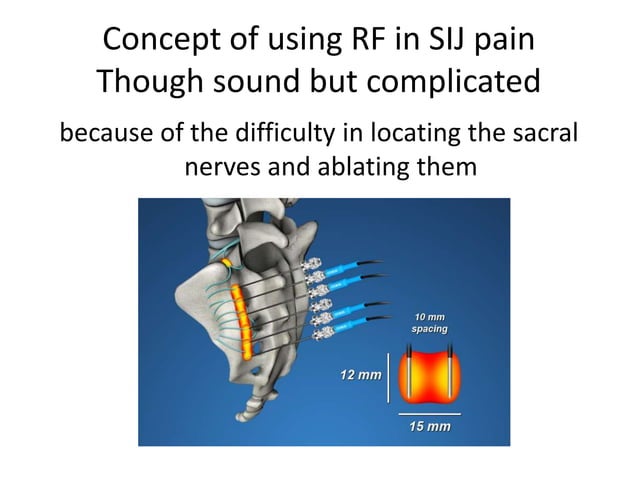Sacroiliac Joint RF Denervation | PPTX | Bone and Joint Conditions ...