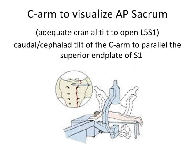 Sacroiliac Joint RF Denervation | PPTX | Bone and Joint Conditions ...