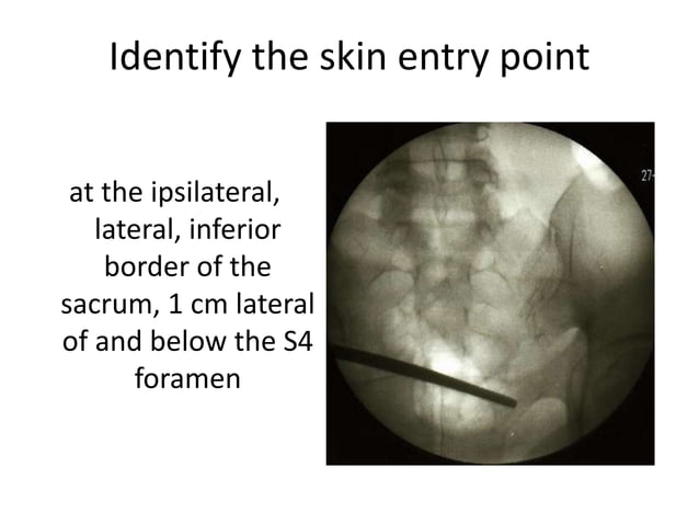 Sacroiliac Joint RF Denervation | PPTX | Bone and Joint Conditions ...
