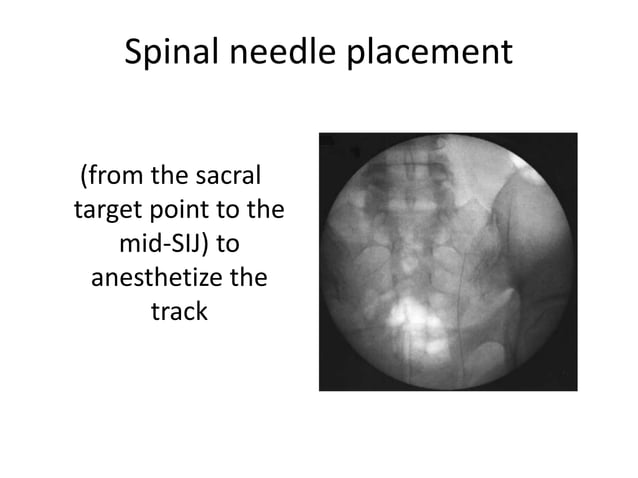 Sacroiliac Joint RF Denervation | PPTX | Bone and Joint Conditions ...