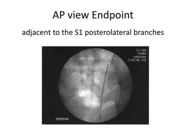Sacroiliac Joint RF Denervation | PPTX | Bone and Joint Conditions ...