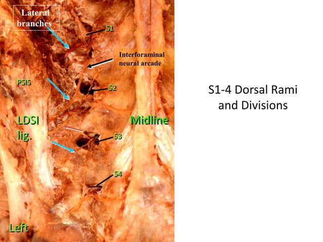 Sacroiliac Joint RF Denervation | PPTX | Bone and Joint Conditions ...