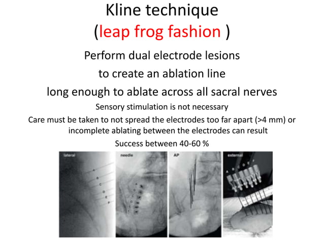 Sacroiliac Joint RF Denervation | PPTX | Bone and Joint Conditions ...