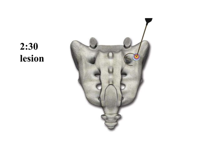 Sacroiliac Joint RF Denervation | PPTX | Bone and Joint Conditions ...