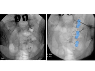 Sacral Foramen Fluoroscopy