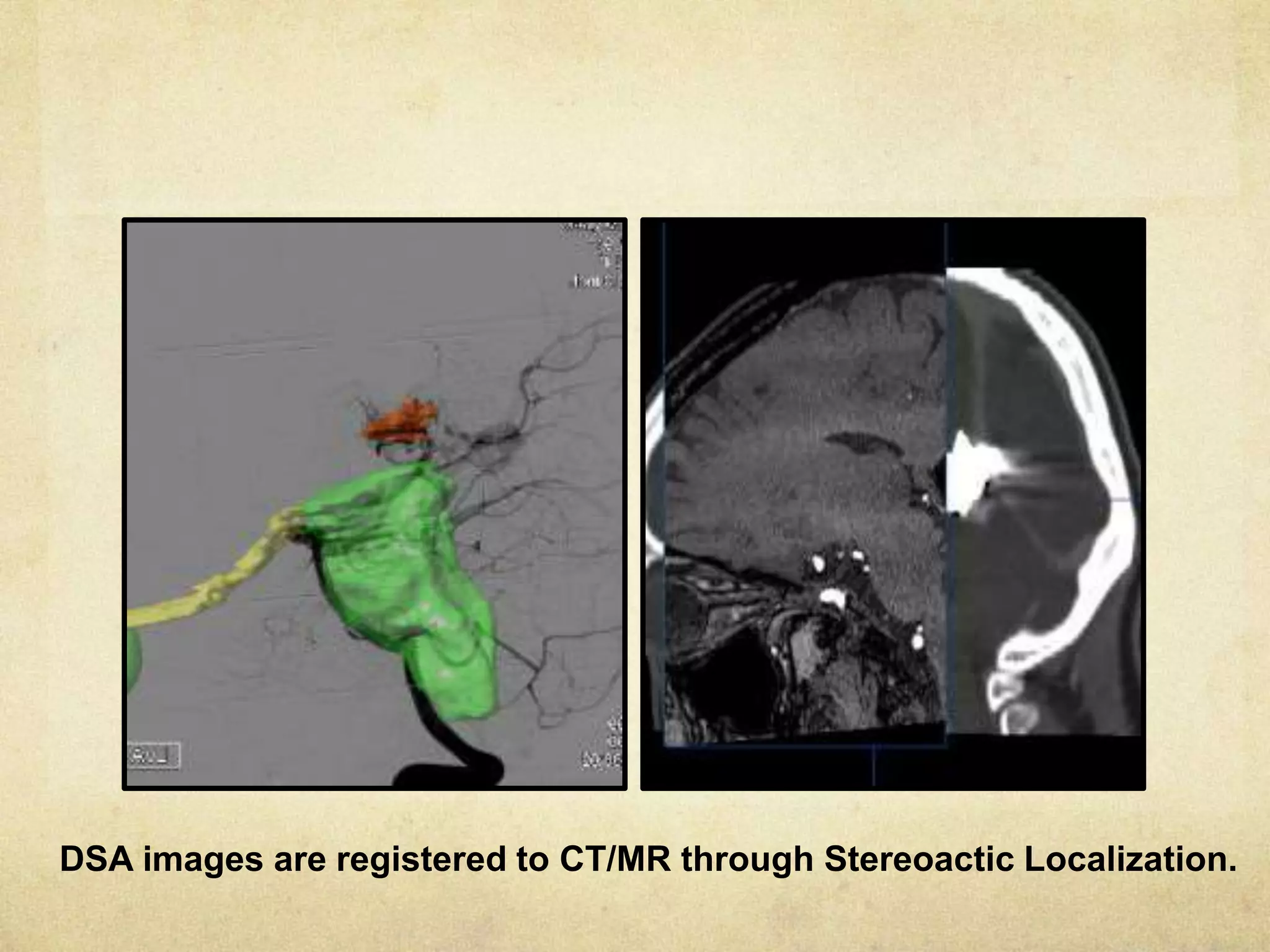 Stereotactic radiosurgery and radiotherapy | PPTX