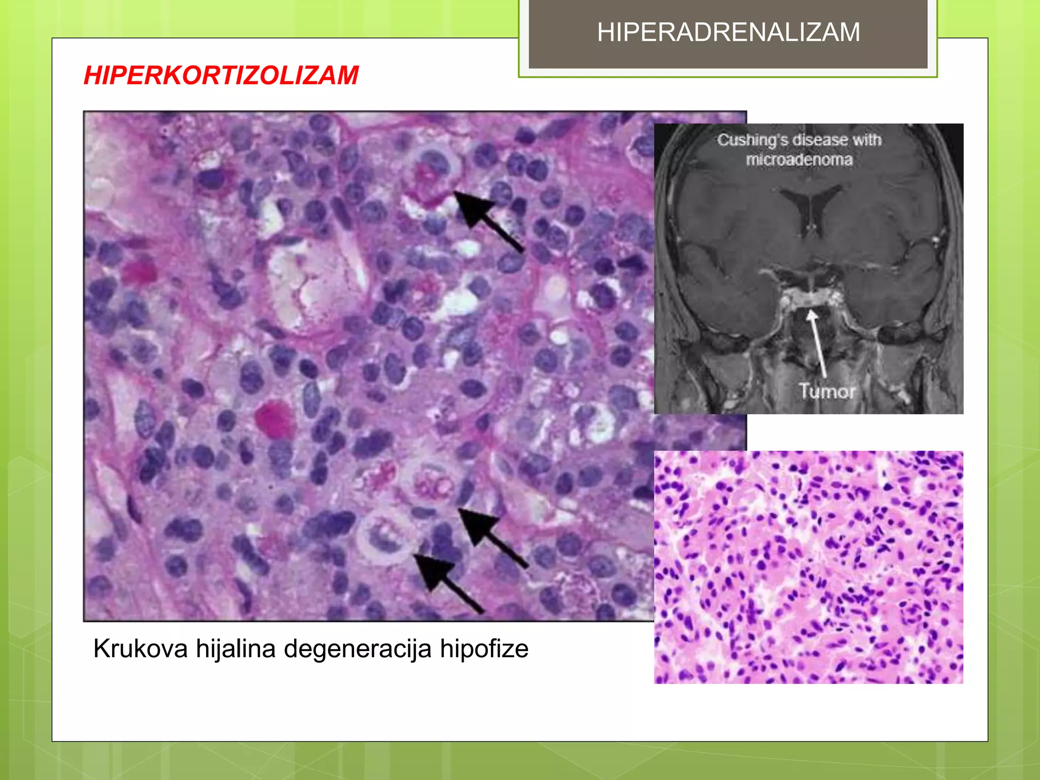 Poremećaji funkcije nadbubrežne žlijezde | PPTX