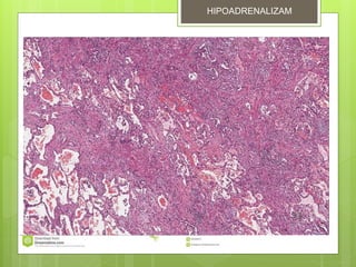Poremećaji funkcije nadbubrežne žlijezde | PPTX
