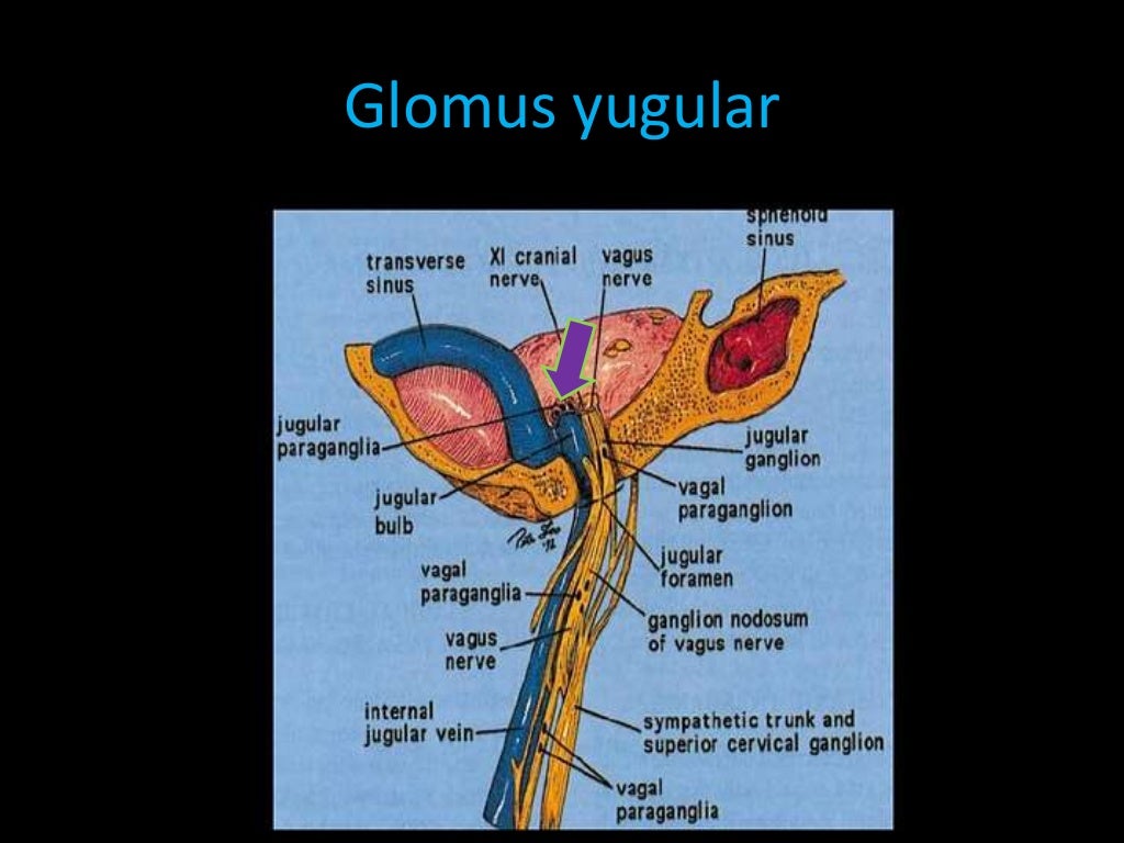 GLOMUS YUGULAR PDF