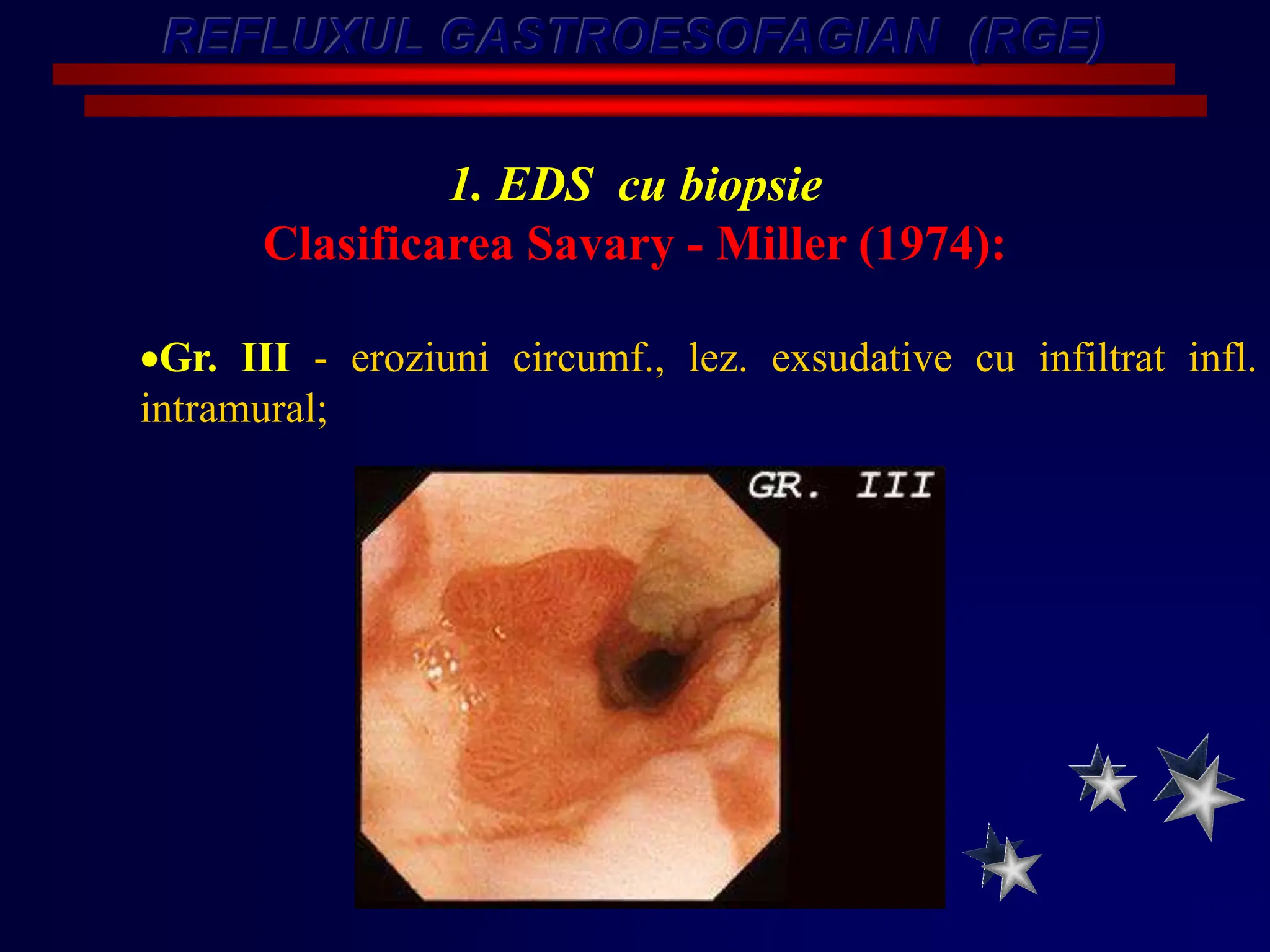 RGE BOALA DE REFLUX GASTROESOFAGIAN .ppt