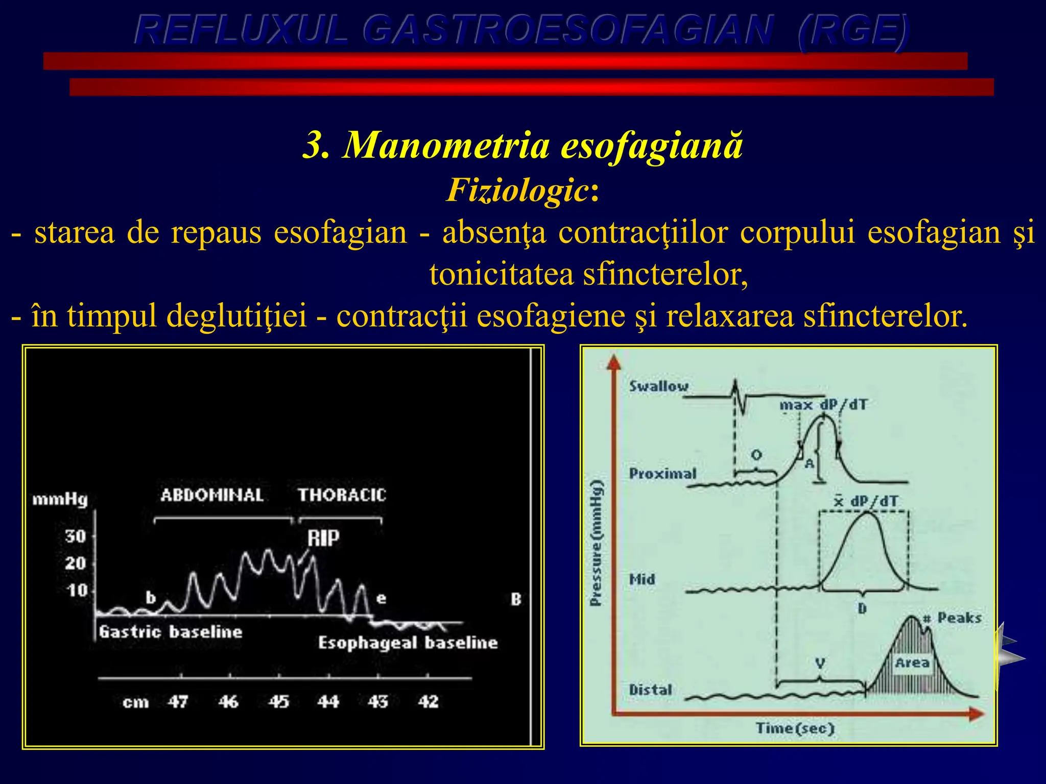 RGE BOALA DE REFLUX GASTROESOFAGIAN .ppt