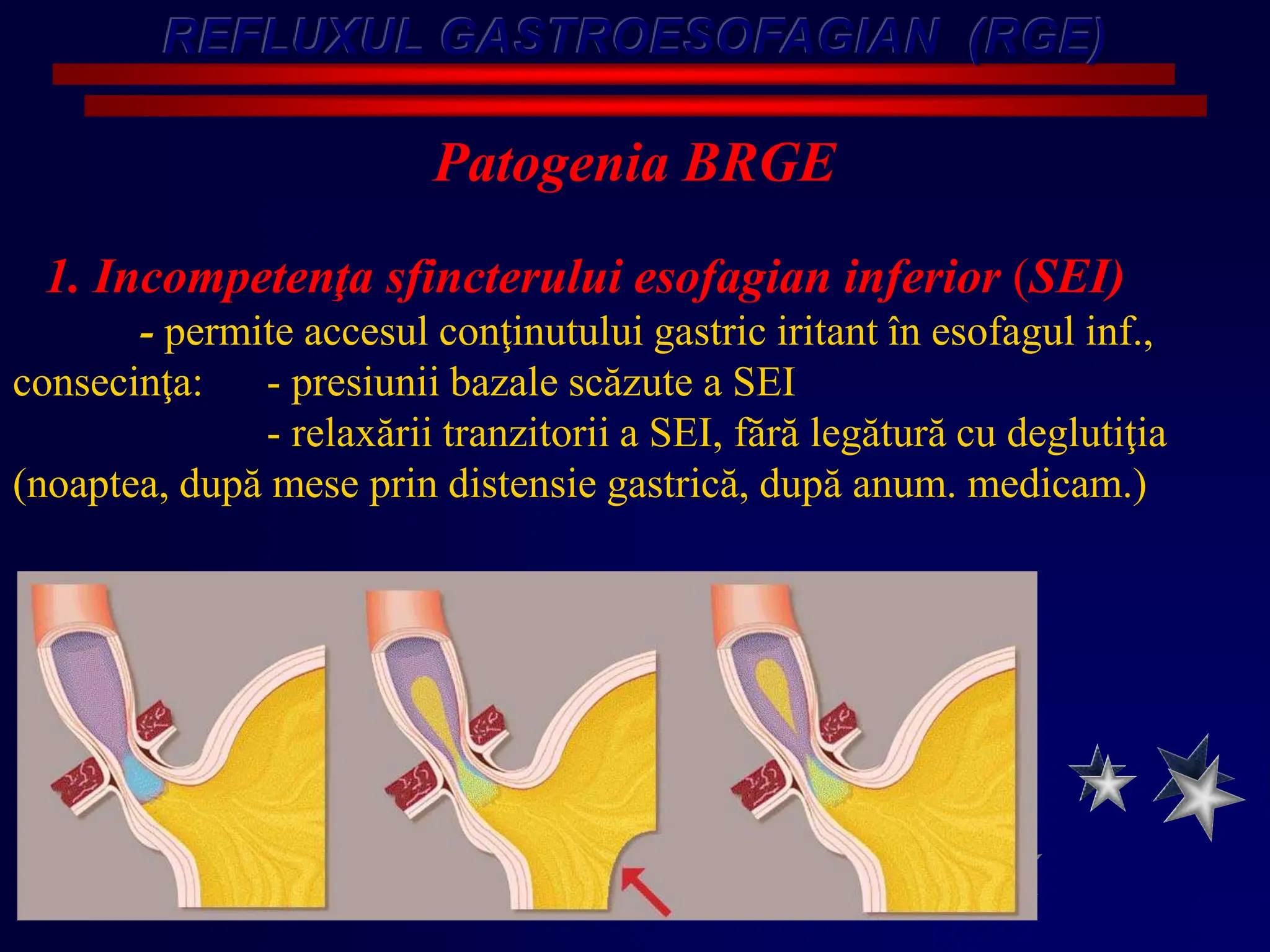 RGE BOALA DE REFLUX GASTROESOFAGIAN .ppt