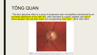 R glaucoma.pptx