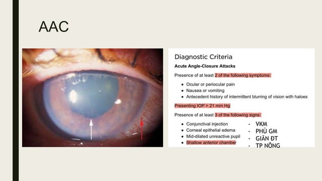 R glaucoma.pptx