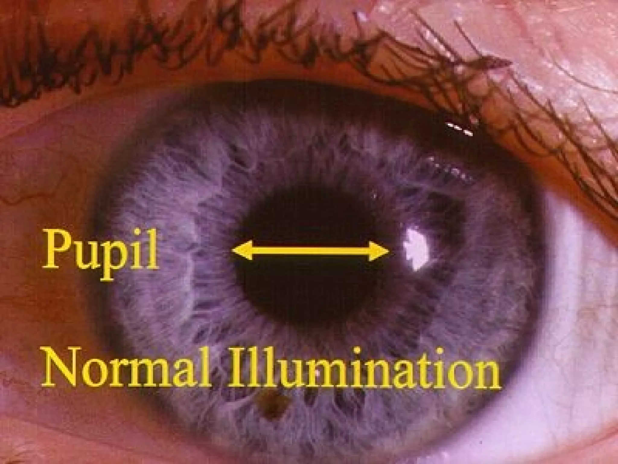 fitting RGP lenses | PPT