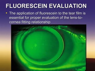 fitting RGP lenses | PPT