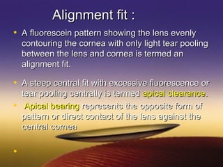 fitting RGP lenses | PPT