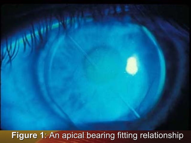 fitting RGP lenses | PPT