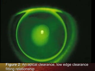 fitting RGP lenses | PPT