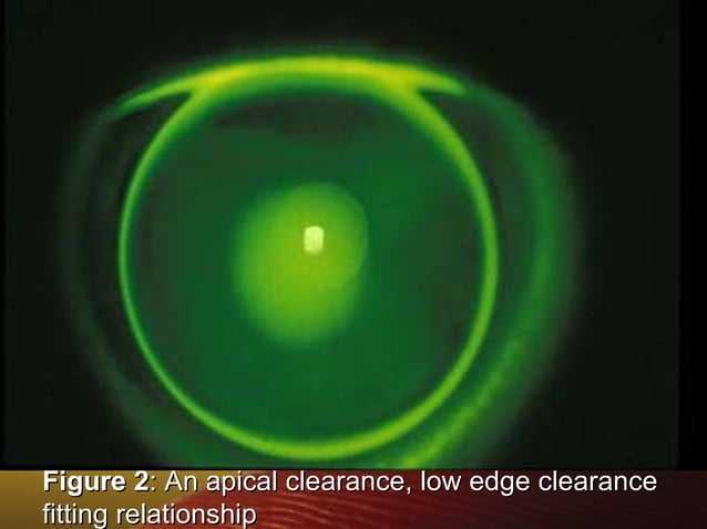 fitting RGP lenses | PPT