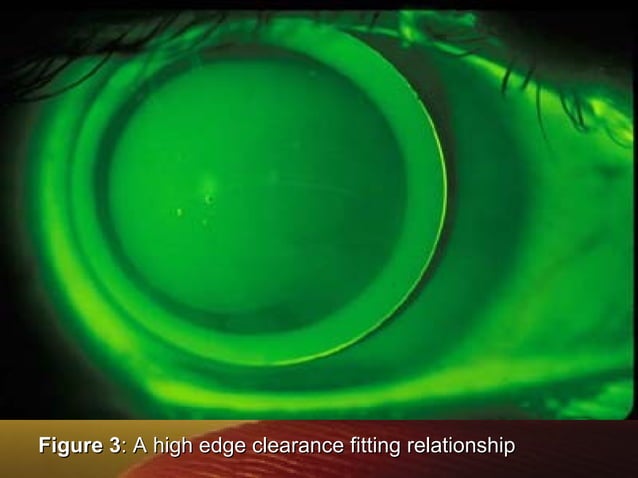fitting RGP lenses | PPT