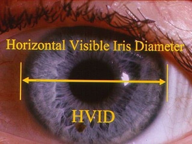 fitting RGP lenses | PPT