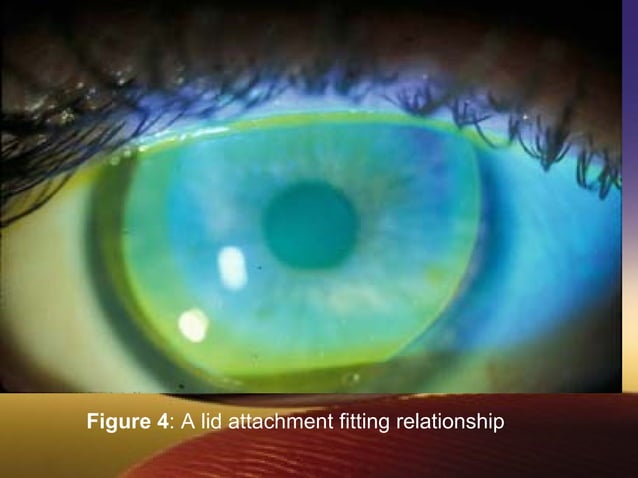 fitting RGP lenses | PPT