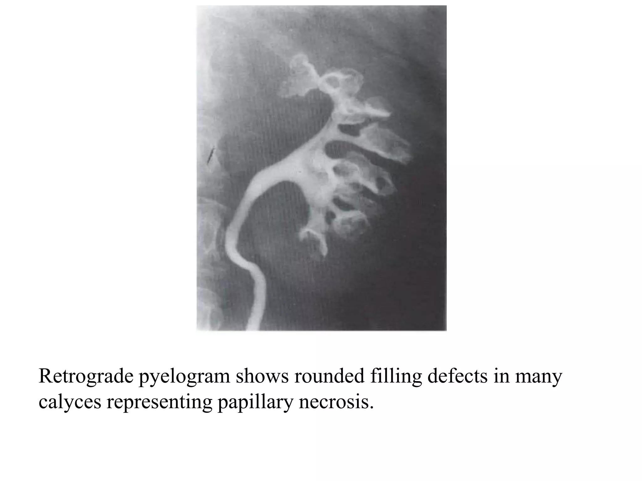 Retrograde Pyelography | PPTX