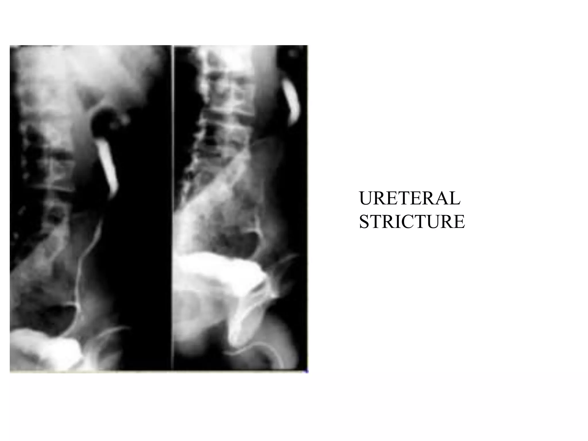 Retrograde Pyelography | PPTX