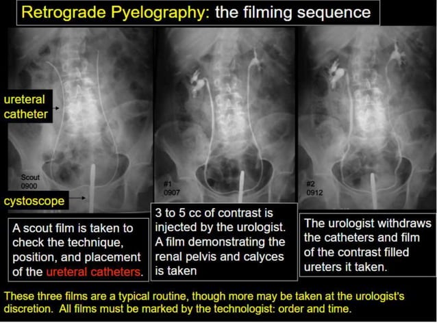 Retrograde Pyelography | PPTX | Digestive Disorders | Diseases and ...