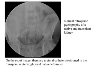 Retrograde Pyelography | PPTX