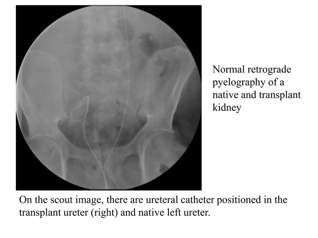 Retrograde Pyelography | PPTX | Digestive Disorders | Diseases and ...